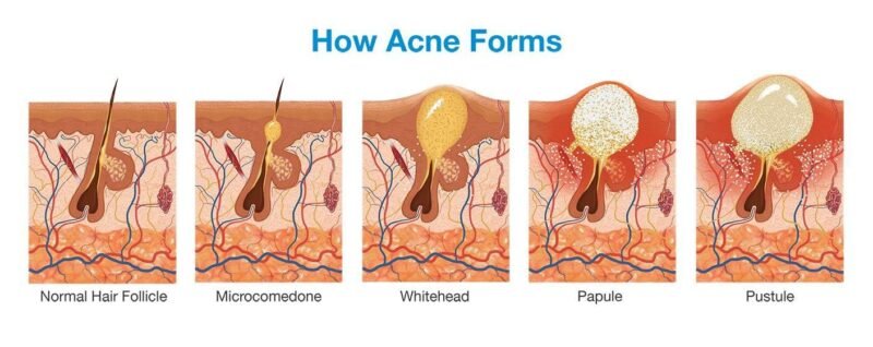 How Acne Forms - Dr. Health Clinic