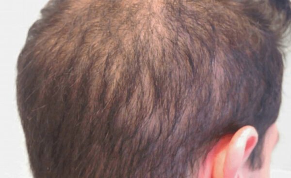Diffuse Unpatterned Alopecia – DUPA -Dr. Health Clinic