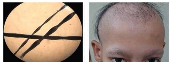 Hair Loss Due To Genetic Hair Shaft Defects - Dr. Health Clinic