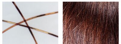 Hair Loss Due To Genetic Hair Shaft Defects - Dr. Health Clinic