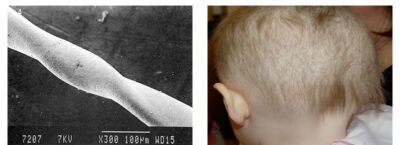 Hair Loss Due To Genetic Hair Shaft Defects - Dr. Health Clinic