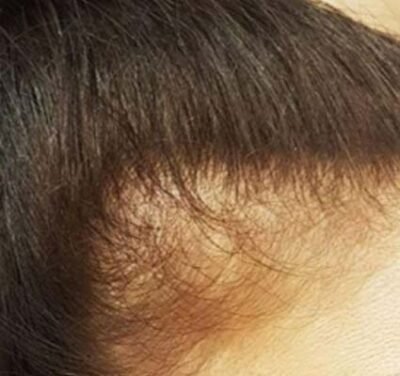 Women’s Hair Loss Treatment - Dr. Health Clinic