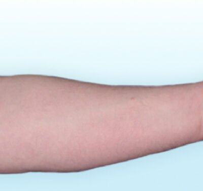 Psoriasis Treatment - Dr. Health Clinic