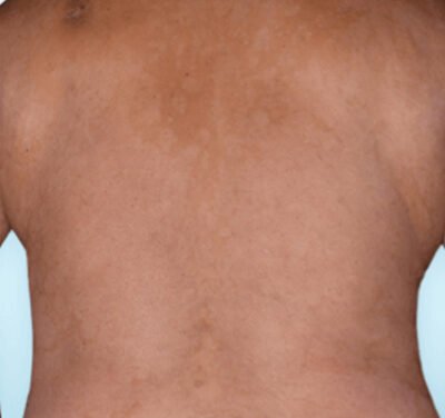 Psoriasis Treatment - Dr. Health Clinic