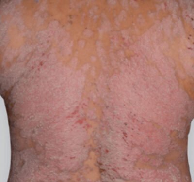 Psoriasis Treatment - Dr. Health Clinic