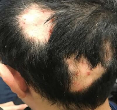 Alopecia Areata Treatment - Dr. Health Clinic