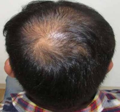 Men’s Hair Loss Treatment - Dr. Health Clinic